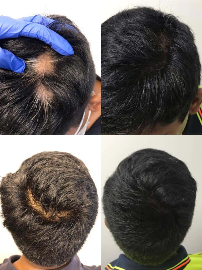 IV Biotin Vitamin Drip for Hair | IM Biotin Booster for Hair Loss